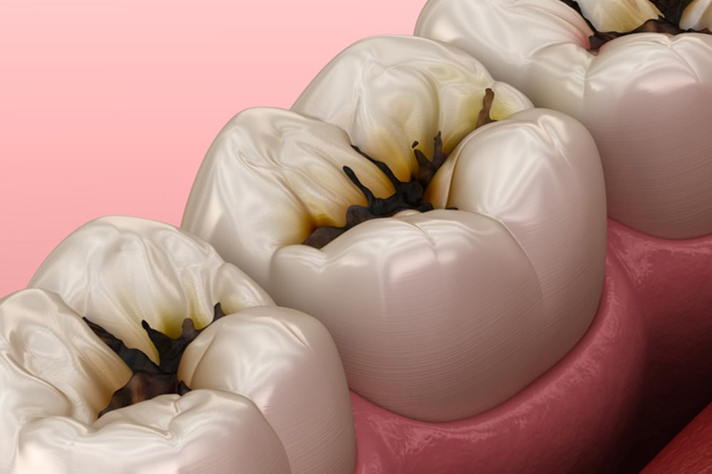 Τερηδόνα | The Dental Home
